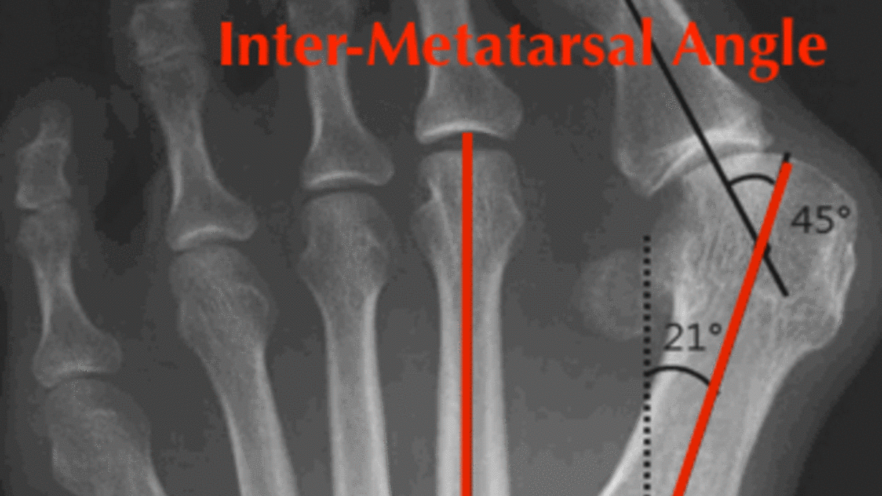 What you must know about treating HAV conservatively