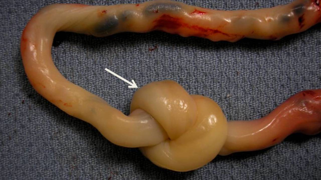Our Miracle Baby Her Umbilical Cord Tied In A True Knot Our Miracle Baby Her Umbilical Cord Tied In A True Knot