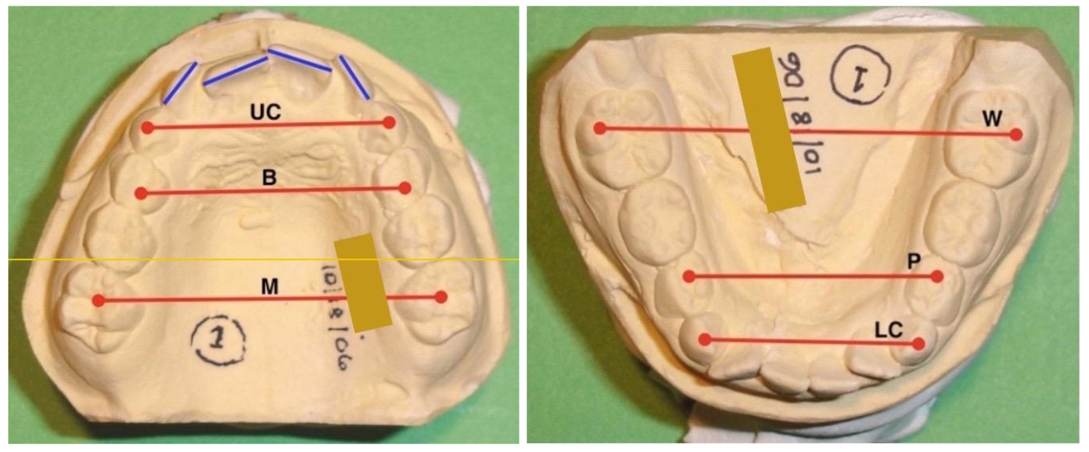 Instructions for Pont's Index